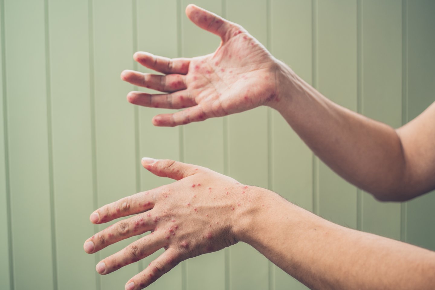 Lietuvoje netikėtai didelis tymų protrūkis: patarė, ką daryti susidūrus ...