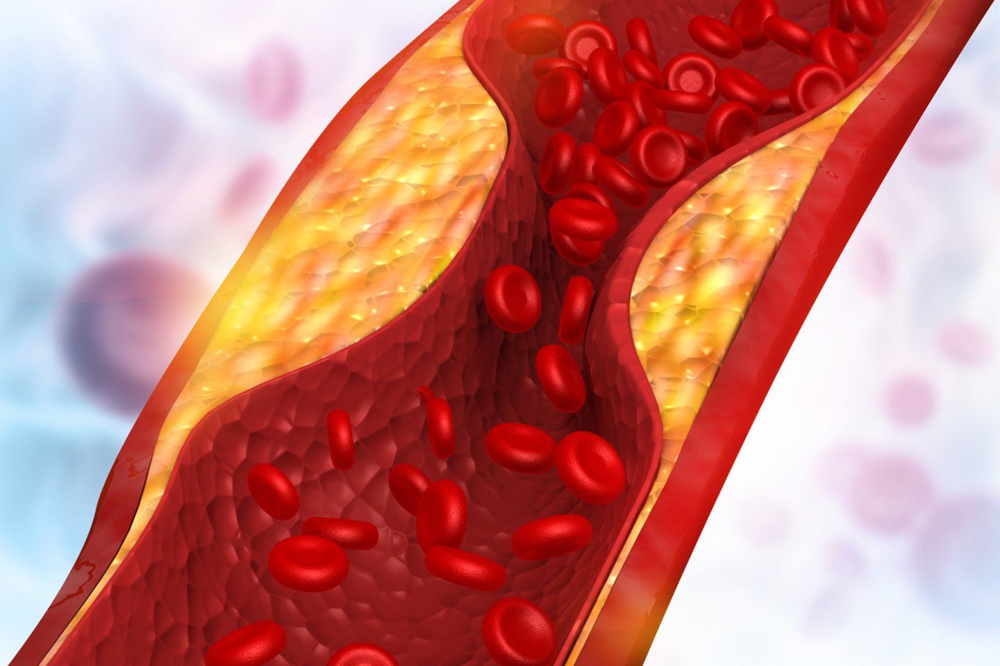 Kardiologė – apie cholesterolio kiekio kraujyje tyrimus: pacientai ...