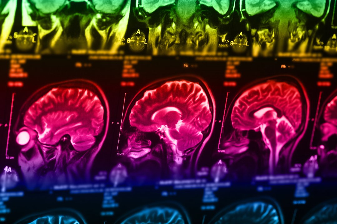 Epilepsija – ne tik traukuliai: gydytojas įvardijo mažiau atpažįstamą ...